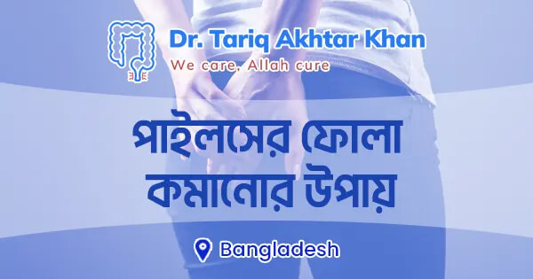 পাইলসের ফোলা কমানোর উপায়